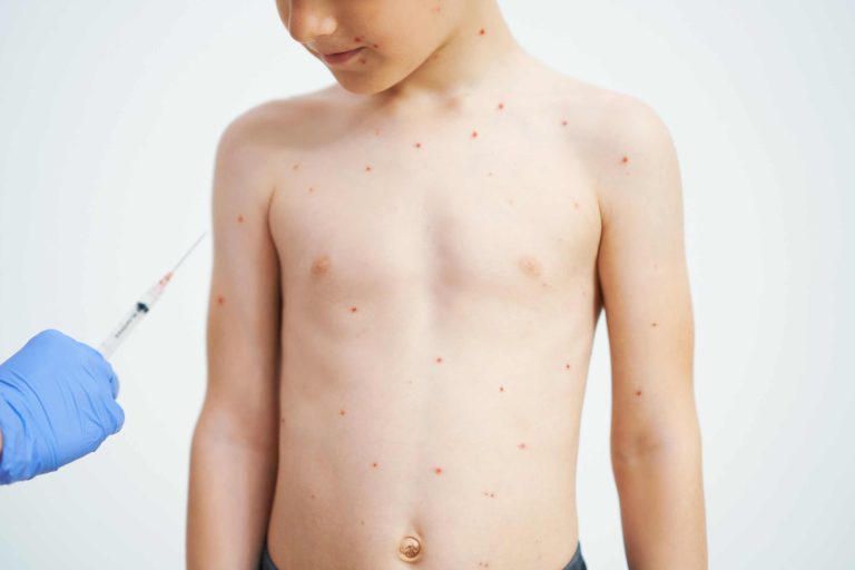 Key Facts On Chickenpox Symptoms And Their Treatments