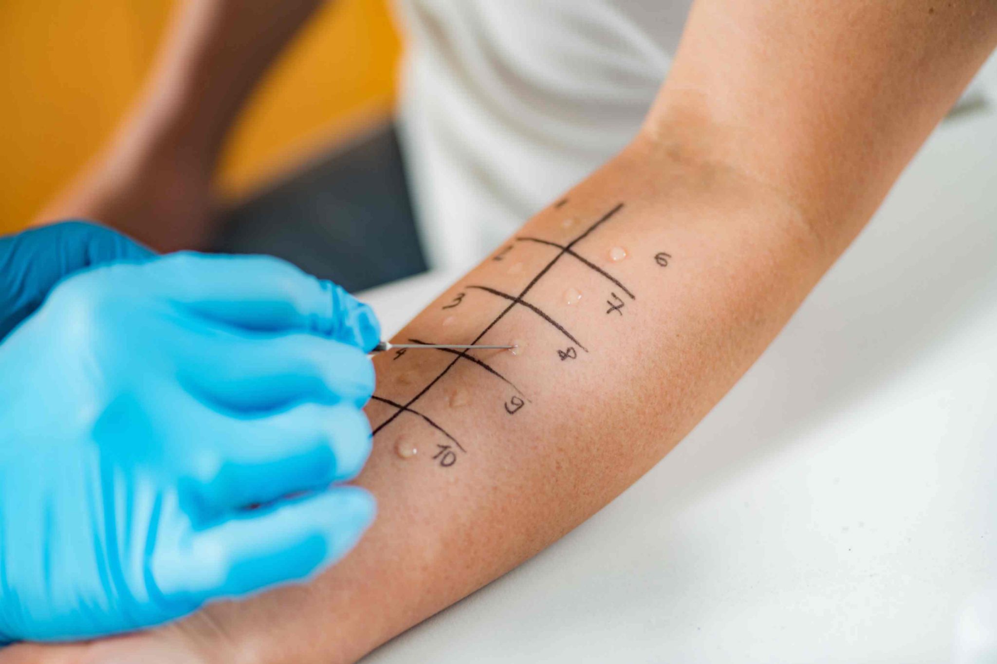 What Are The Different Methods For Allergy Testing?