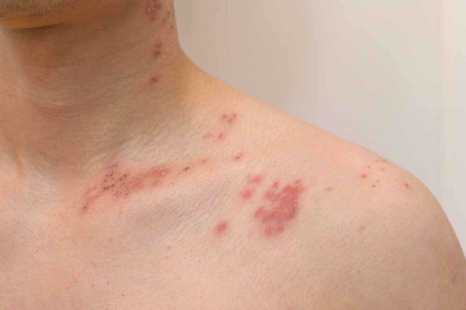What Are the First Signs of Shingles and How Can Vaccination Help ...