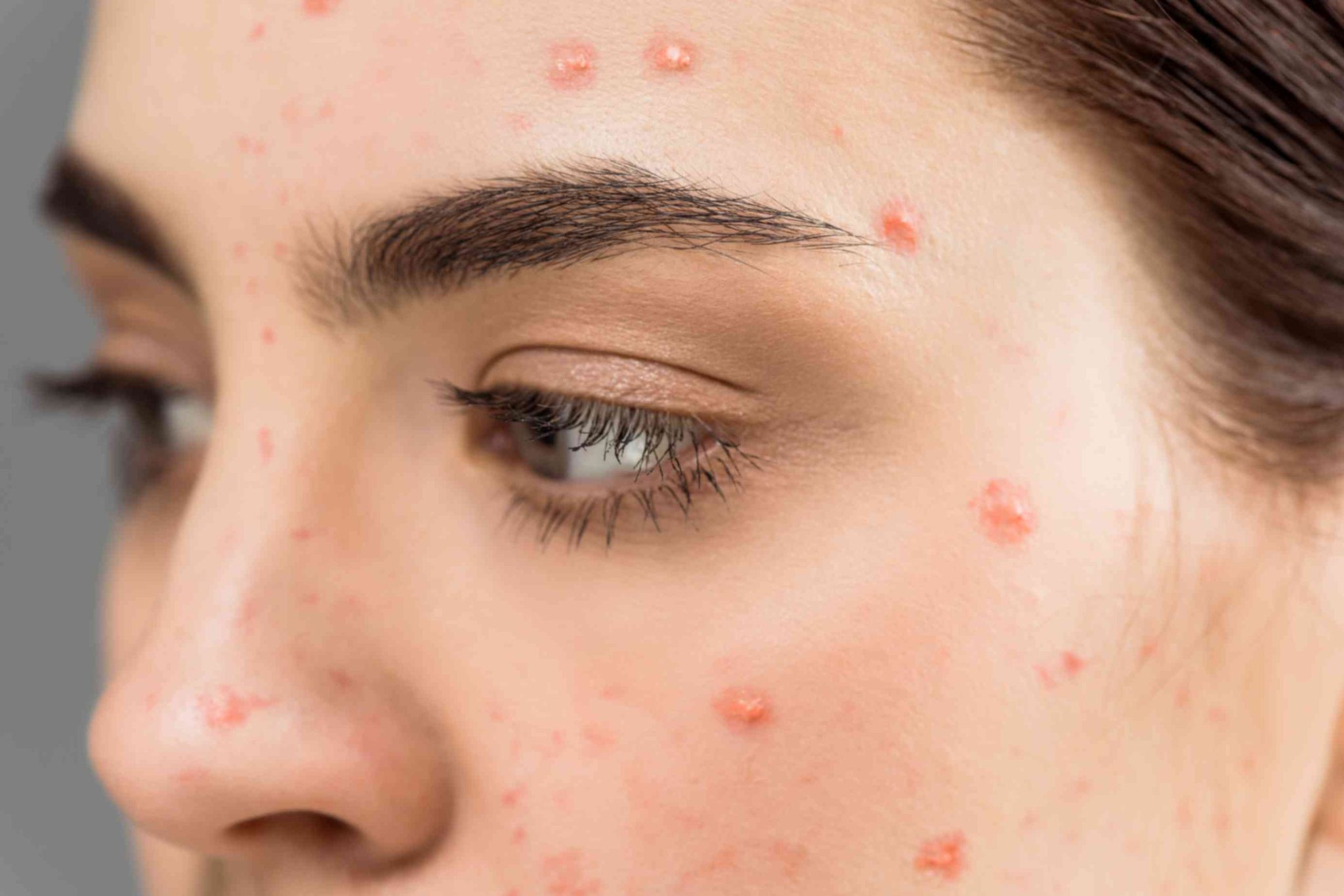 Can Pregnant Women Get Chickenpox and Is It Dangerous? - Touchwood Pharmacy