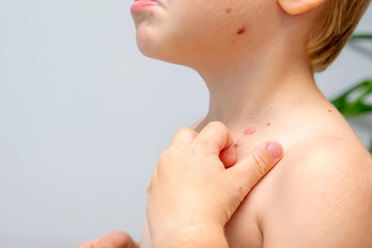 Can Adults Still Get Chickenpox? Symptoms, Risks, and Prevention ...
