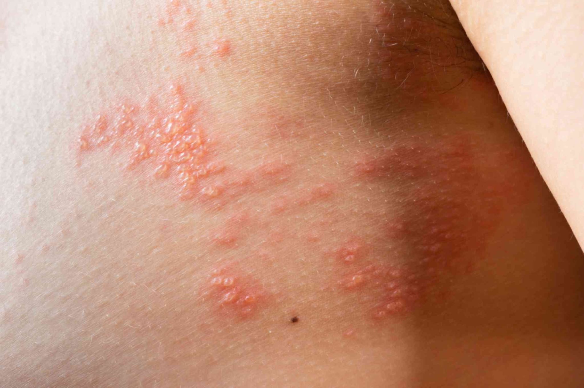 What Are the Early Signs of a Shingles Rash? - Touchwood Pharmacy