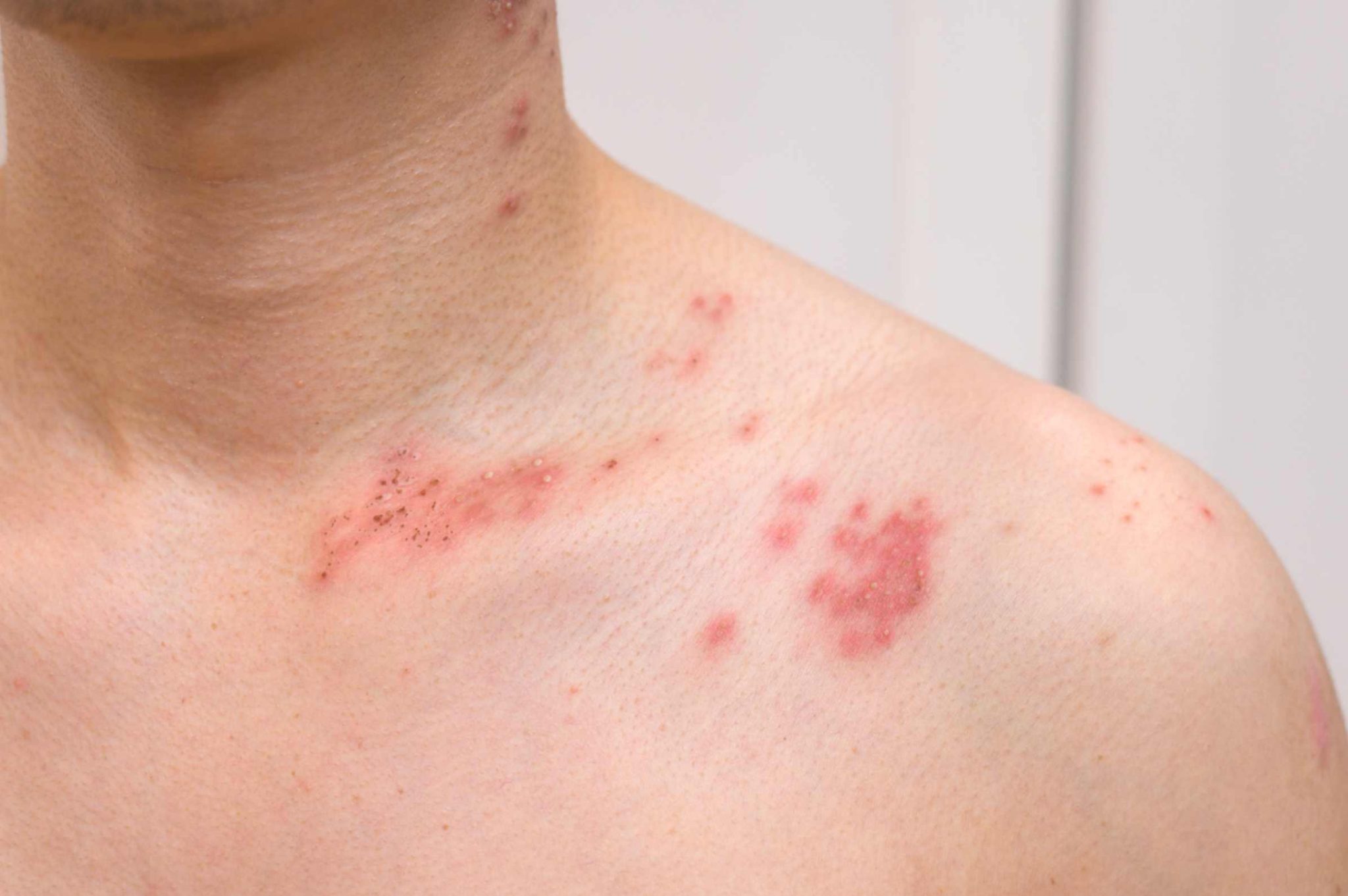 What Does a Shingles Rash Look Like in Its First Stages? - Touchwood ...