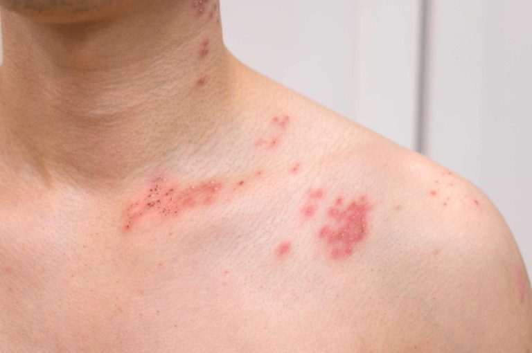 What Does a Shingles Rash Look Like in Its First Stages? - Touchwood ...